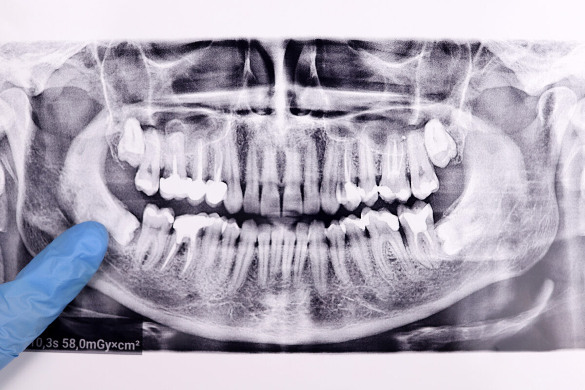 Wisdom Tooth Removal & Extraction Specialist | Tulip Dental